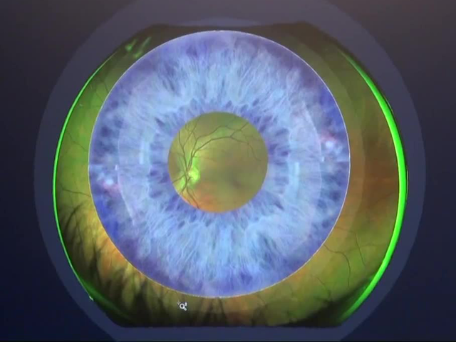 Eclipse blindness: What you should know to avoid damaging your eyes ...